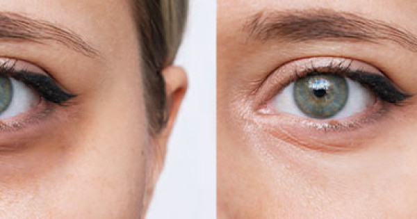 Important Information About Under Eye Bruises